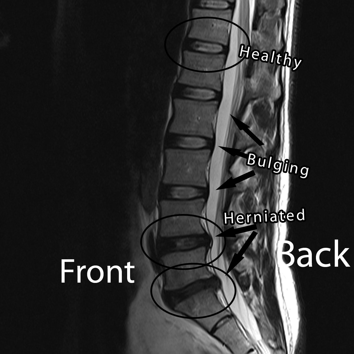 My lower back MRI results